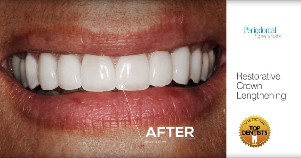 Restorative Crown Lengthening - Dental Implants & Periodontology ...